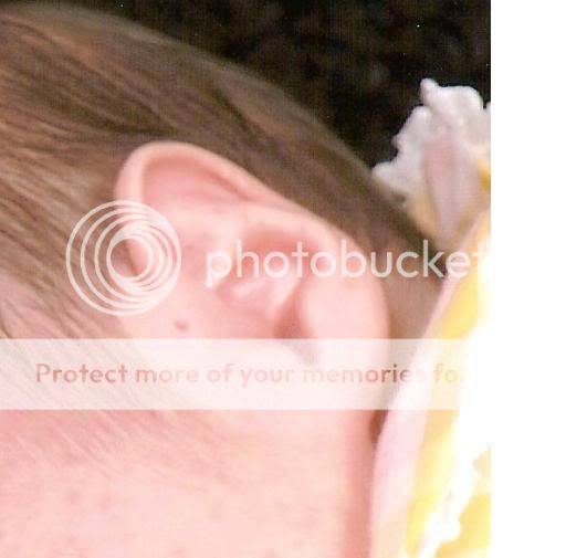 Ear Dimples? | BabyCenter